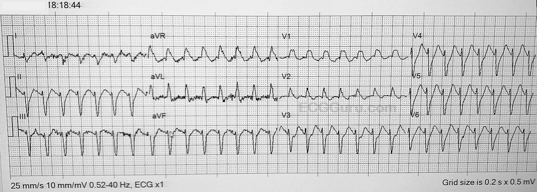 Wide Complex Tachycardia | ECG Guru - Instructor Resources Wide Complex Tachycardia | ECG Guru - Instructor Resources
